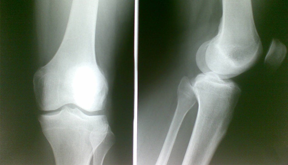 A Climber's Guide to Healthy Knees: 5 Tips for Preventing Knee Injuries